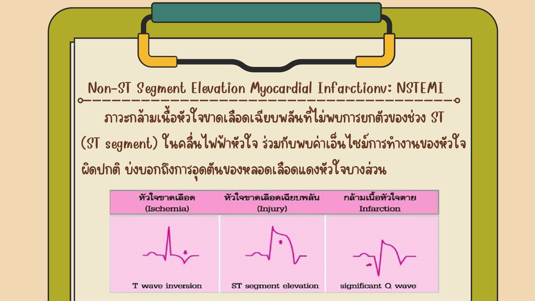 NSTEMI - Phatcharee P - หน้าหนังสือ 2 | พลิก PDF ออนไลน์ | PubHTML5