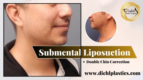 Submental Liposuction for a Defined Jawline and Neck Contour