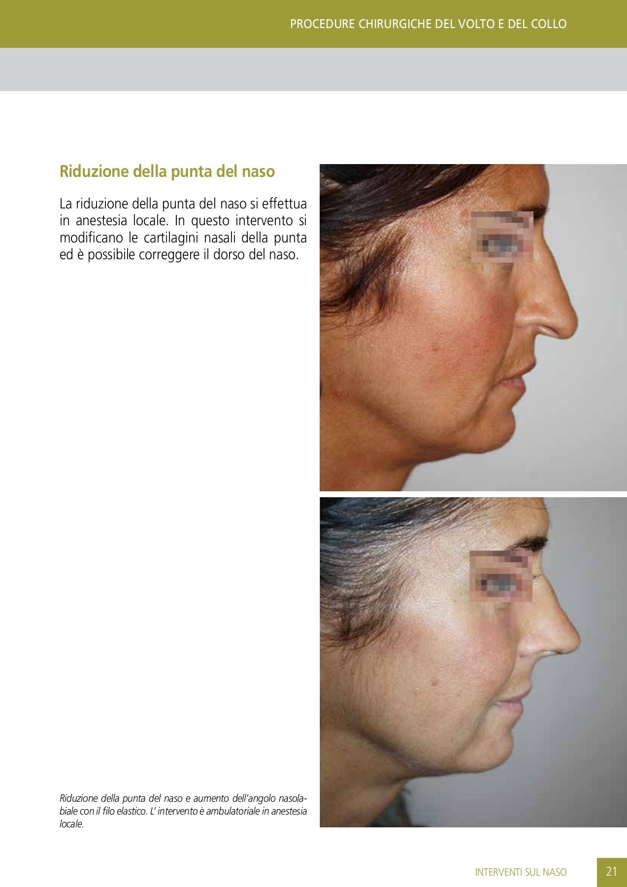 Sezione Procedure chirurgiche Volto e collo - a.odone - Pagina 21 | PDF ...