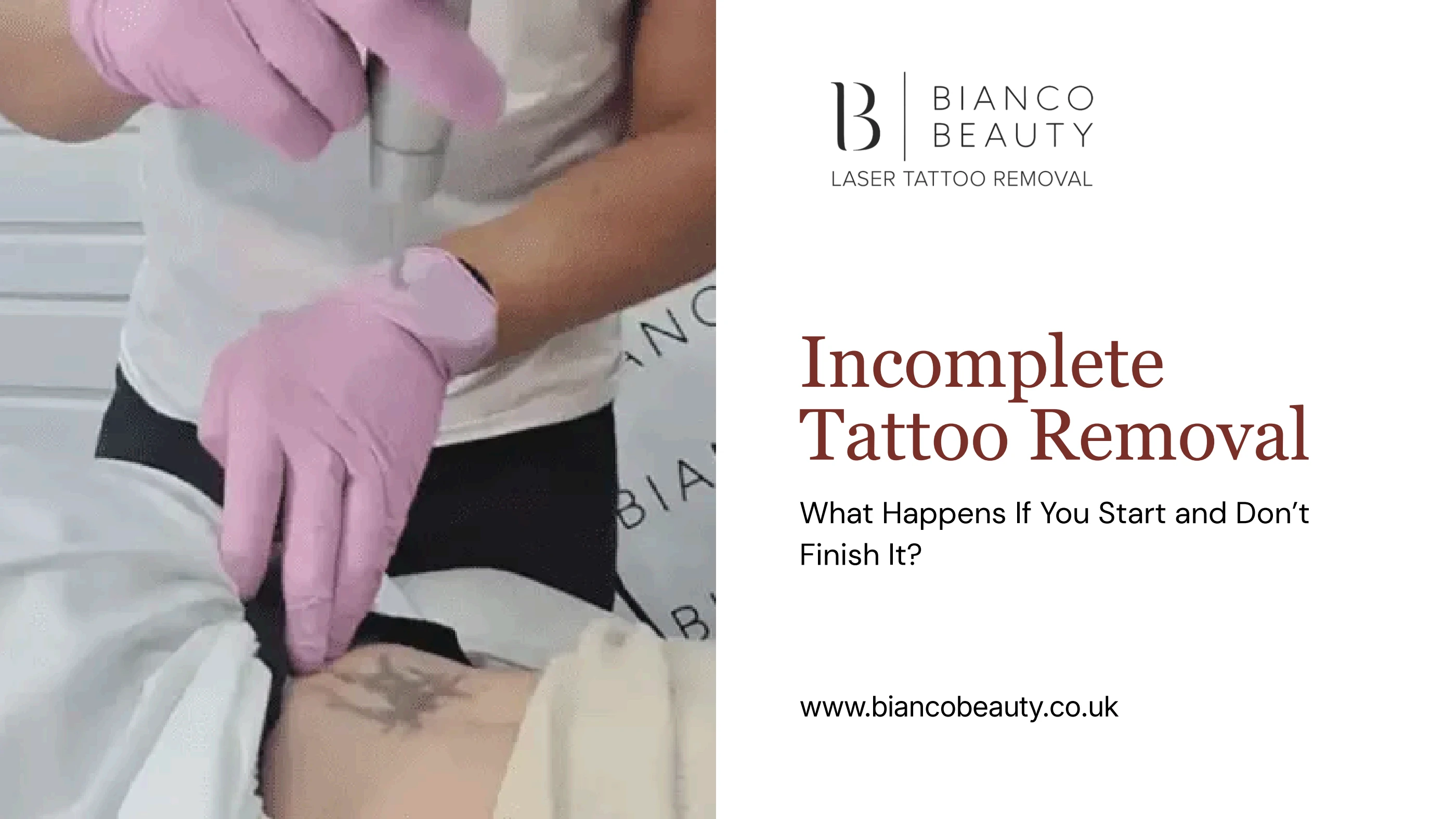 Incomplete Tattoo Removal: What Happens If You Start and Don’t Finish ...