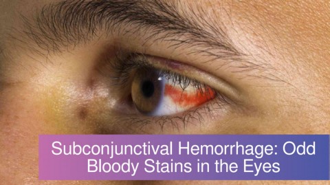 Subconjunctival Hemorrhage: Odd Bloody Stains in the Eyes