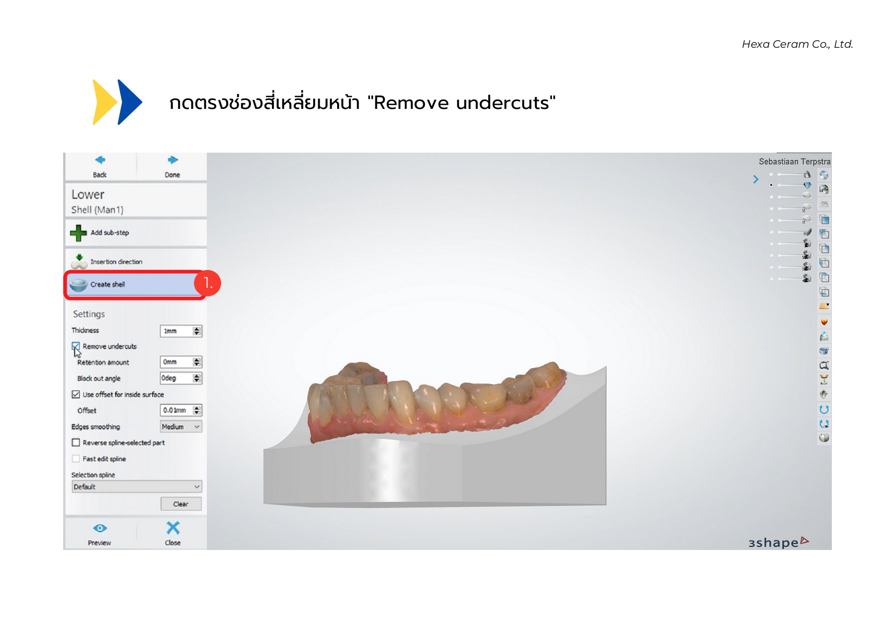 Ortho - Stop (ฟันล่าง) - Hexa Ceram Library - หน้าหนังสือ 7 | พลิก PDF ...
