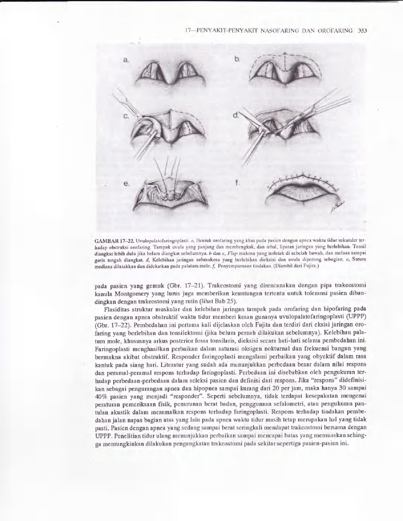 17. PENYAKIT-PENYAKIT NASOFARING DAN OROFARING - haryahutamas - Halaman ...