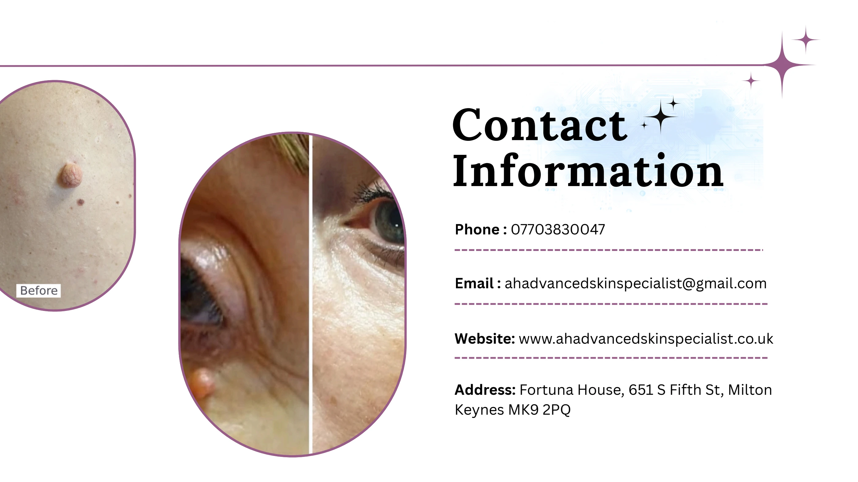 Syringoma Removal Cost Range, Factors Affecting it & How to Choose - A ...