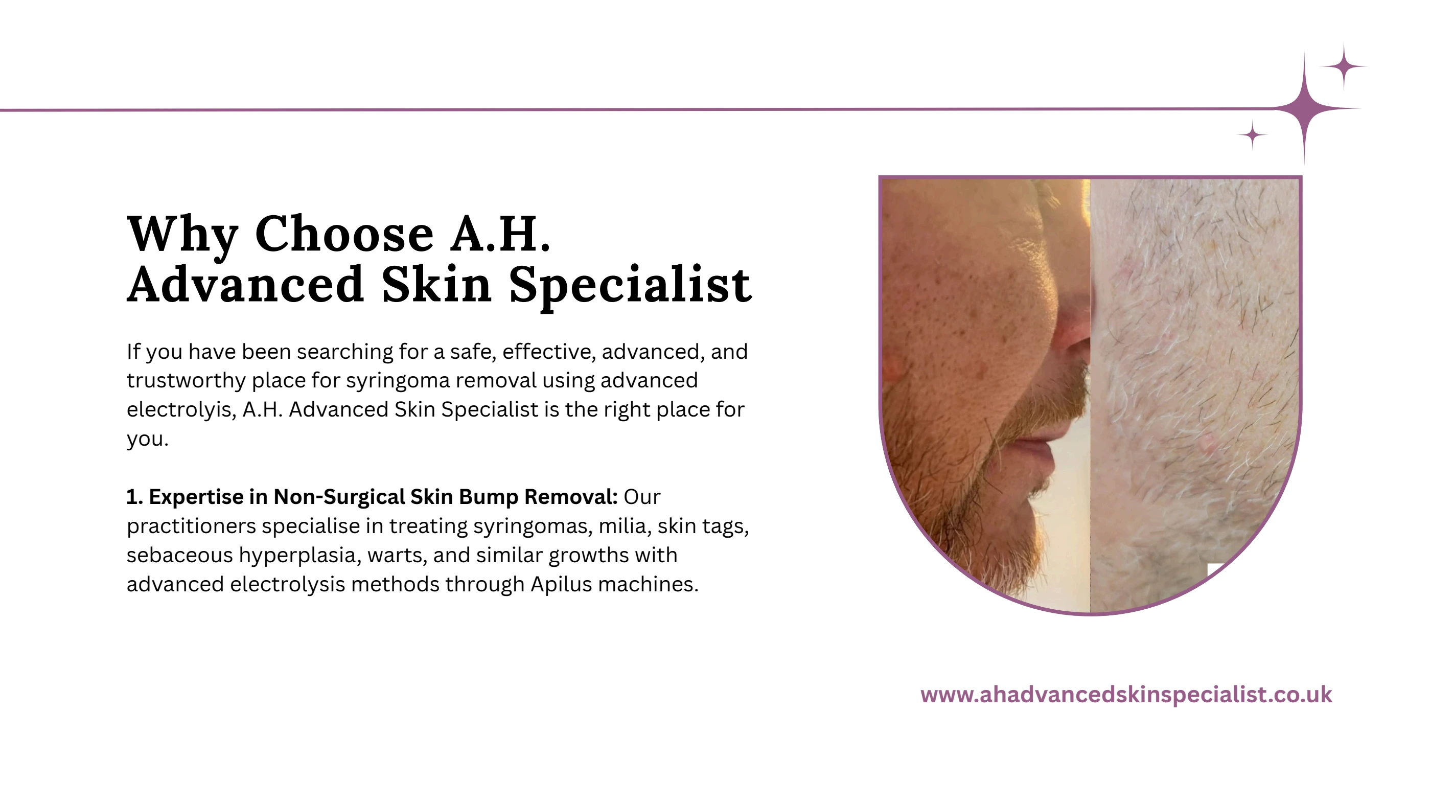 Syringoma Removal Cost Range, Factors Affecting it & How to Choose - A ...