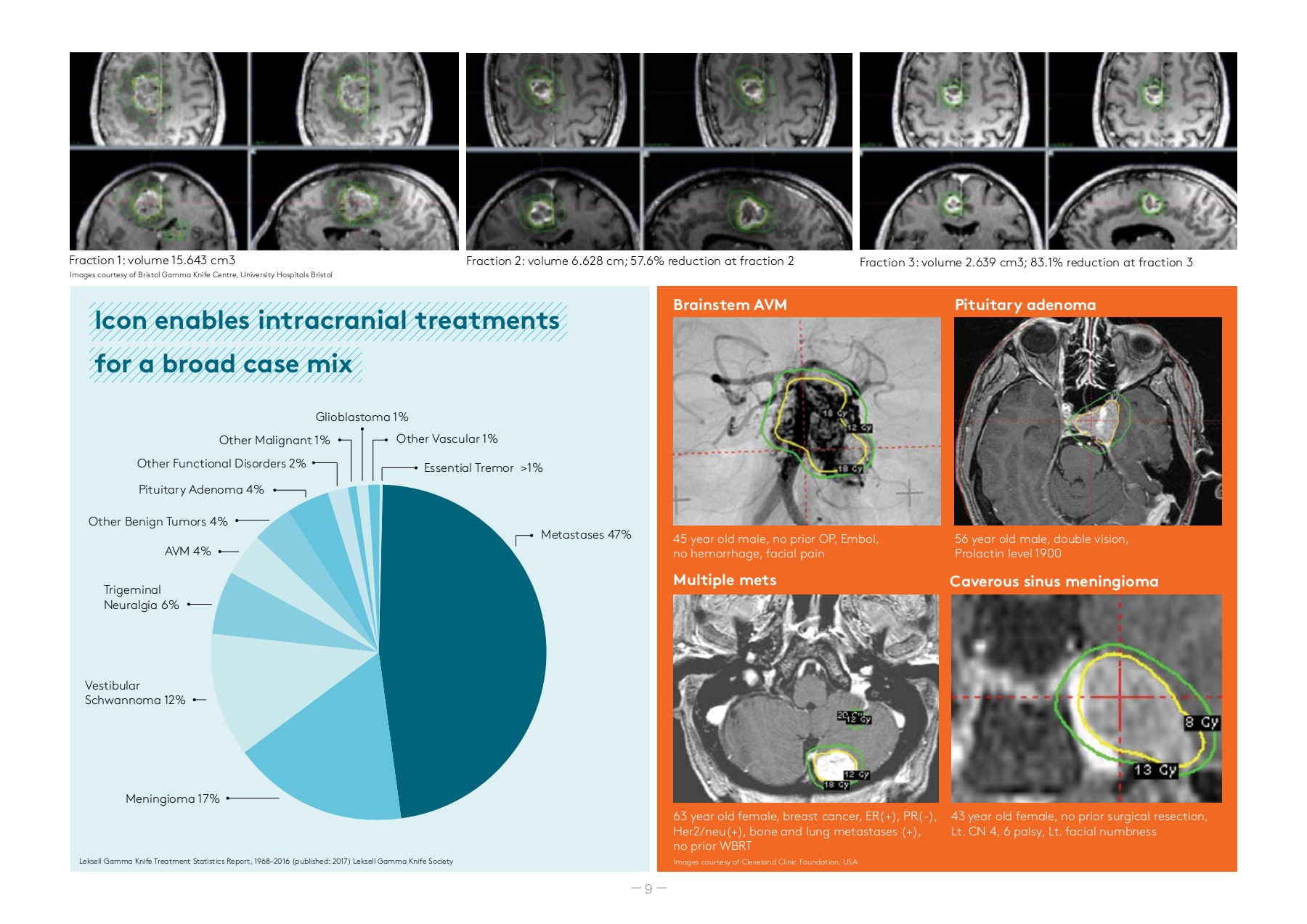 Leksell-Gamma-Knife-Icon-product-brochure - Dew Natrada - Page 11 | Flip PDF Online | PubHTML5