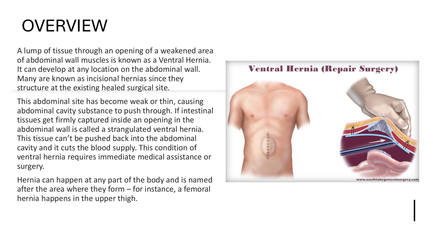 Ventral Hernia Treatment - Southlake General Surgery - Page 2 | Flip ...