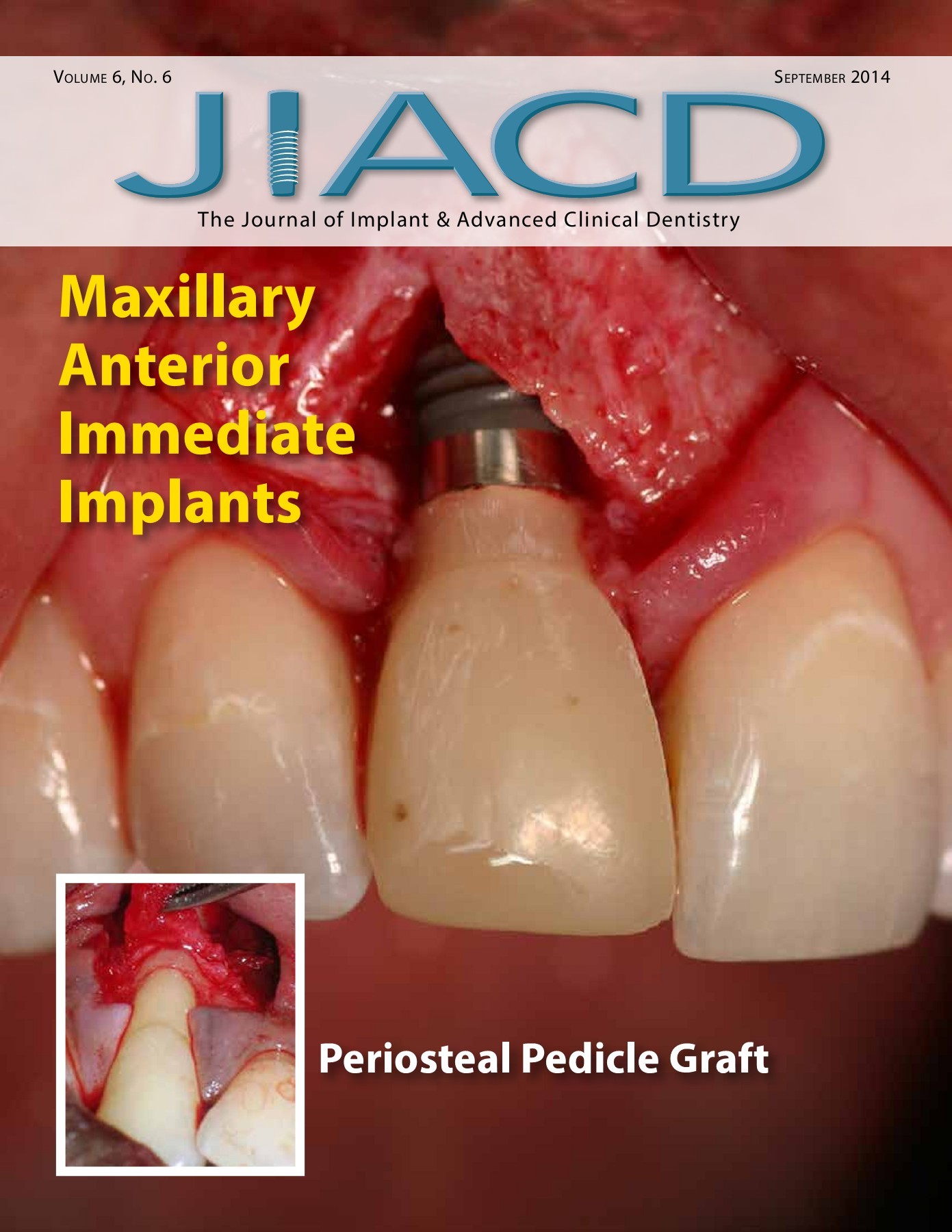 Journal of Implant and Advanced Clinical Dentistry September 2014 ...