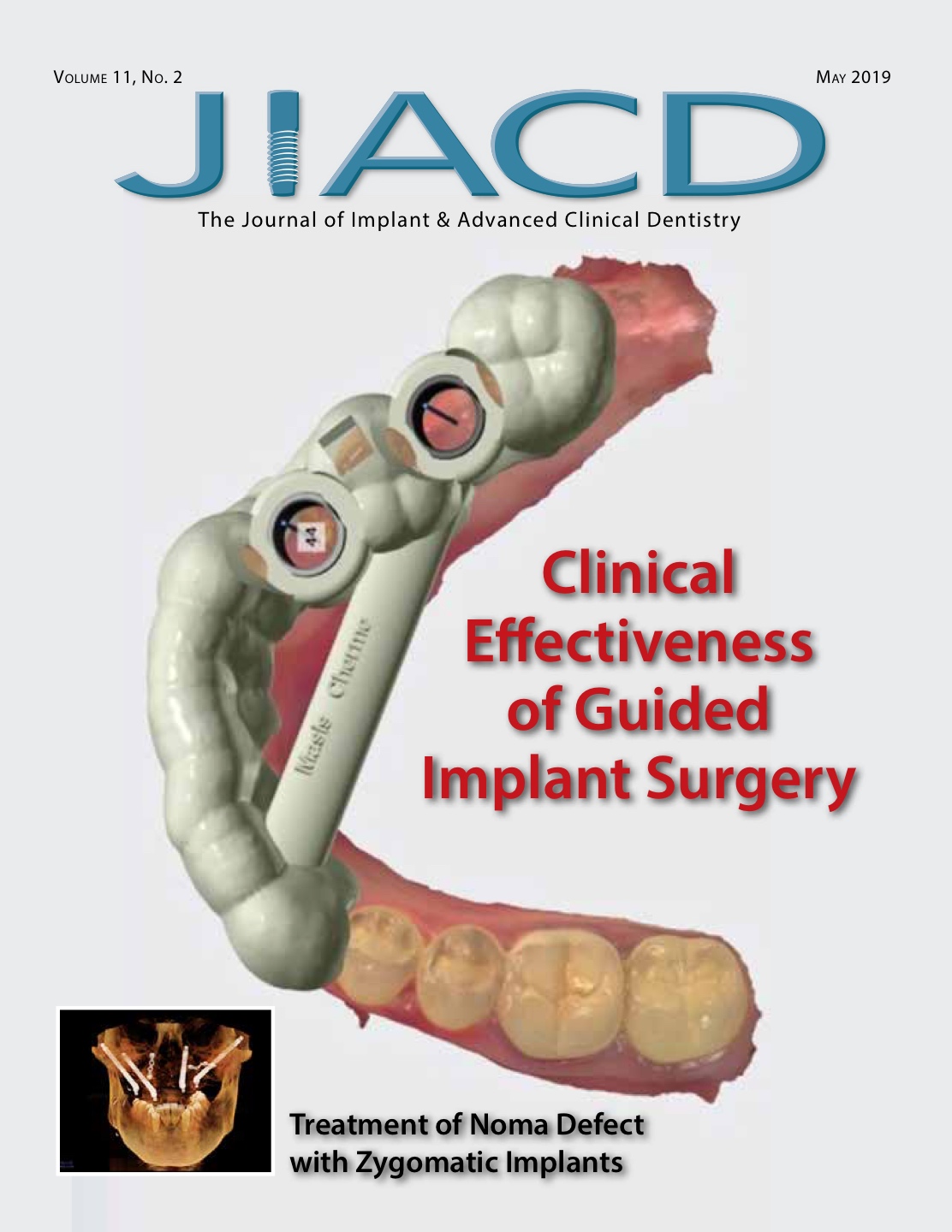Journal of Implant and Advanced Clinical Dentistry May 2019 - JIACD ...