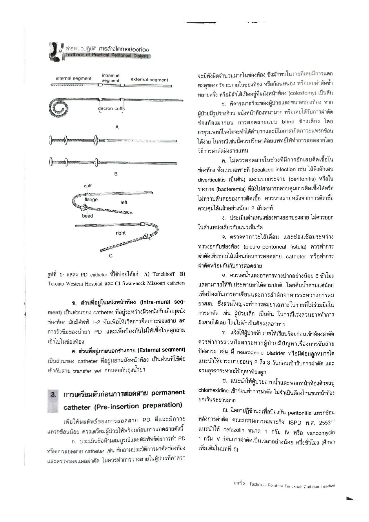 บทที่2 Technical point of Tenckhoff catheter insertion - kati3391 ...