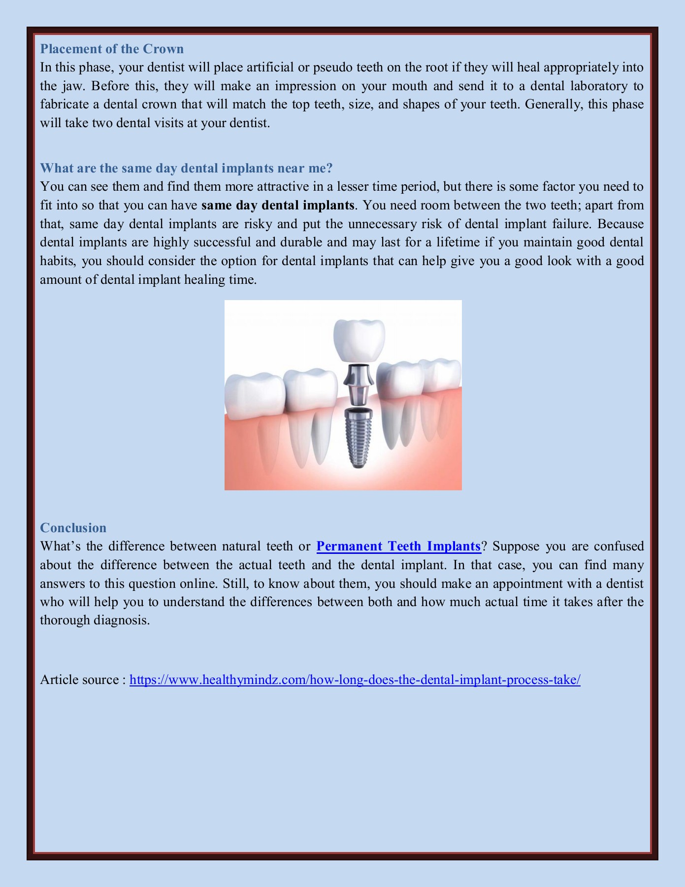 How Long Does The Dental Implant Process Take? - William Noah - Page 2 ...