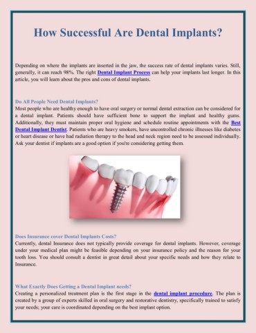 How Successful Are Dental Implants?