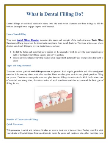 What is Dental Filling Do?